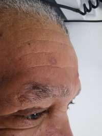 DermaFreeze ® - Cryotherapy of various benign skin and mucosal lesions