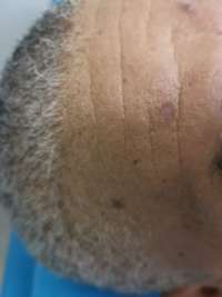 DermaFreeze ® - Cryotherapy of various benign skin and mucosal lesions