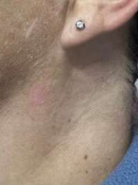 DermaFreeze ® - Cryotherapy of various benign skin and mucosal lesions